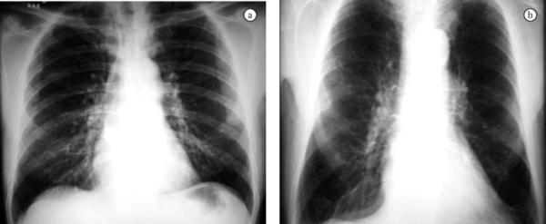 Chronic Obstructive Pulmonary Disease (COPD) and Acute Exacerbations of ...