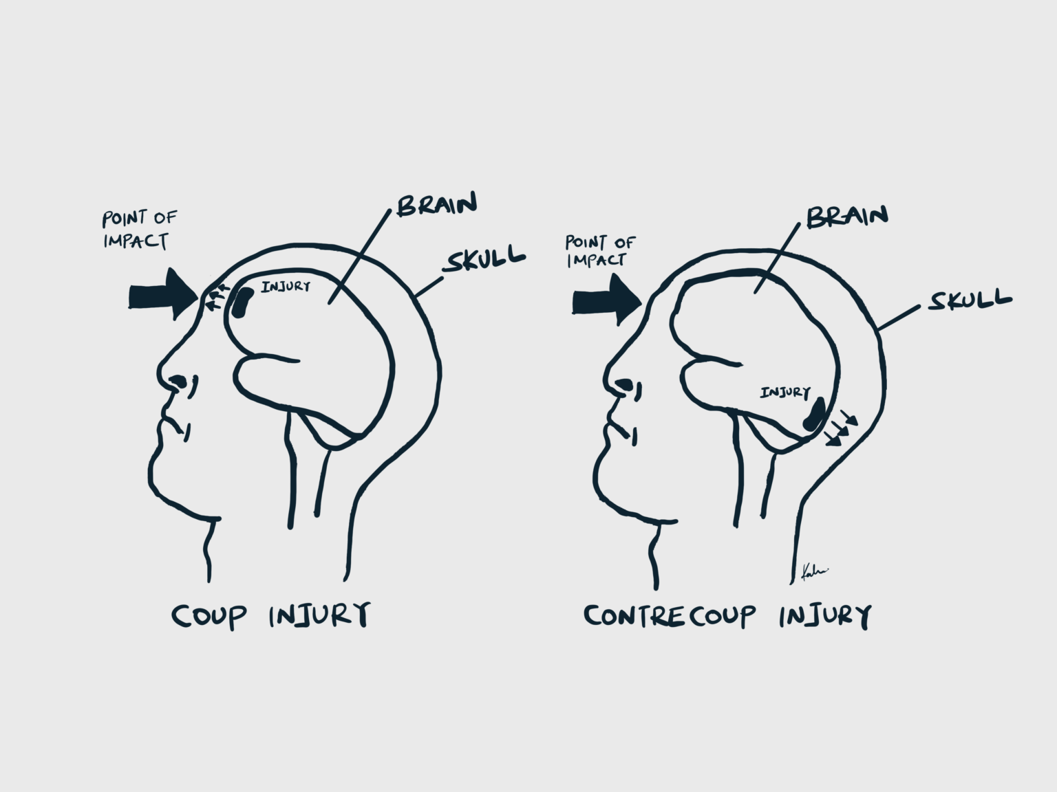 A 45-year-old who lost consciousness following head trauma – Hyperexcision
