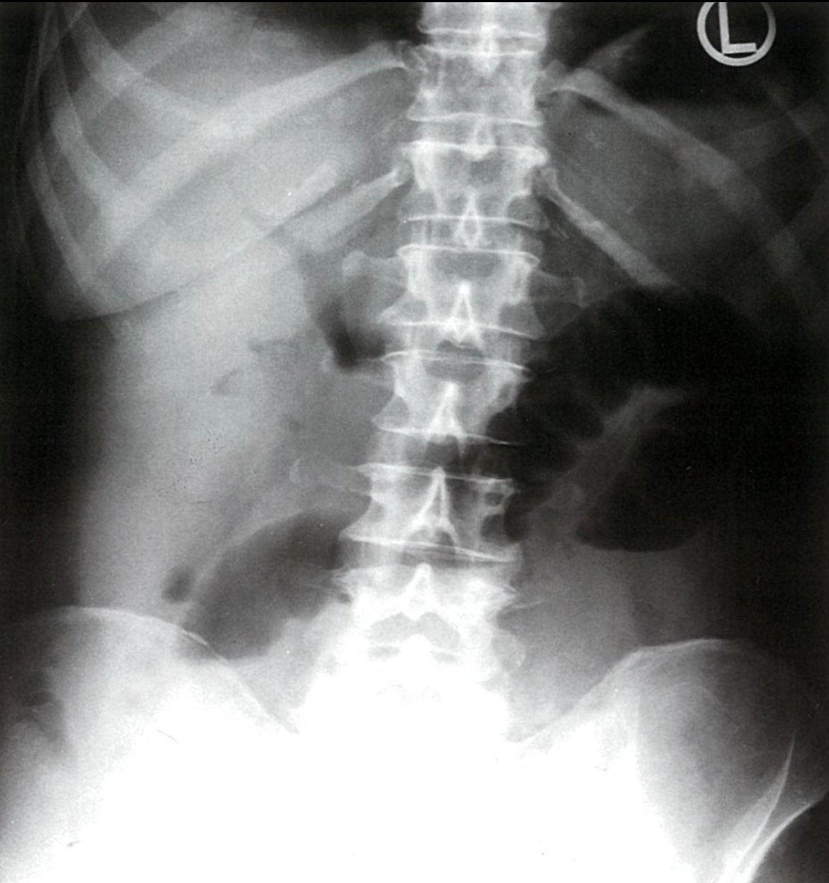 Gallbladder - Hyperexcision
