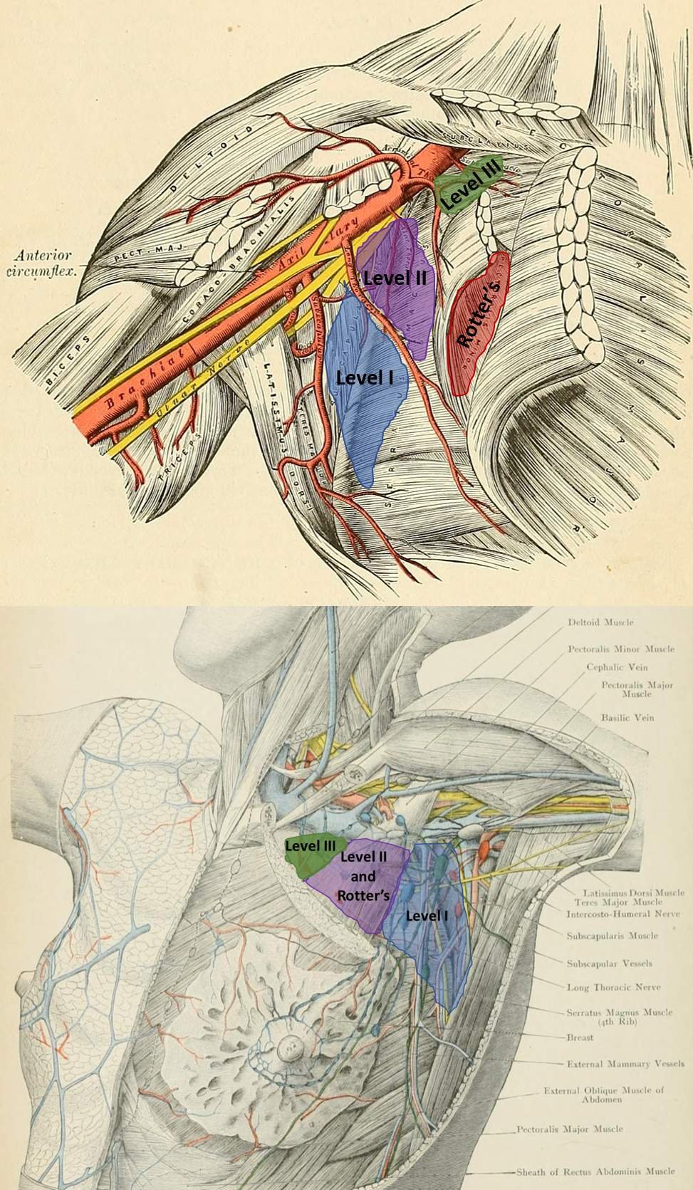 Breast Masses - Hyperexcision