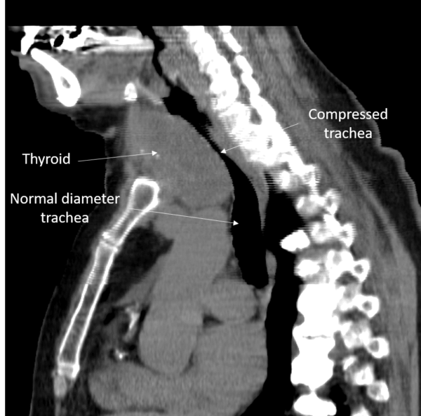 Thyroid Nodules and Cancer - Hyperexcision