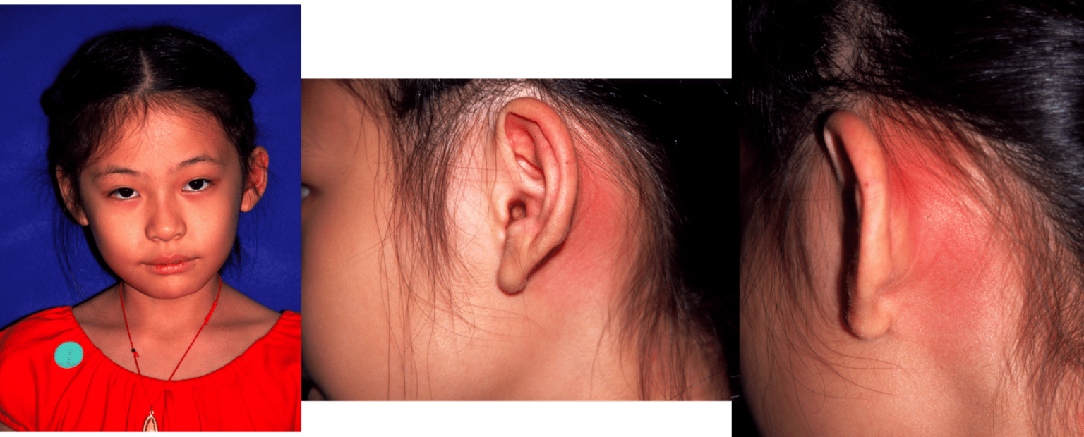 Acute Otitis Media (AOM) - Hyperexcision