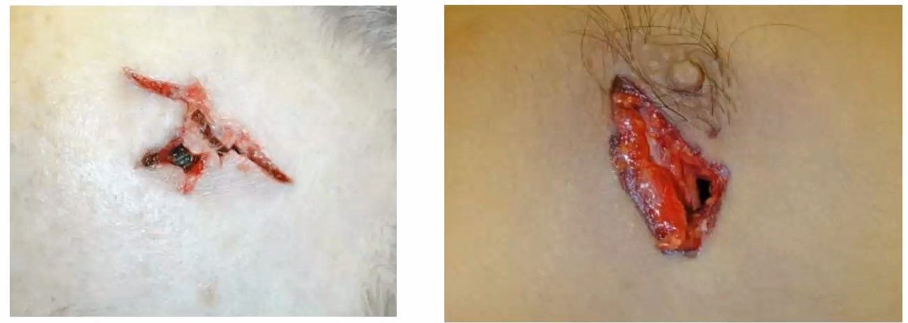 Firearms and Firearm Identification - Hyperexcision
