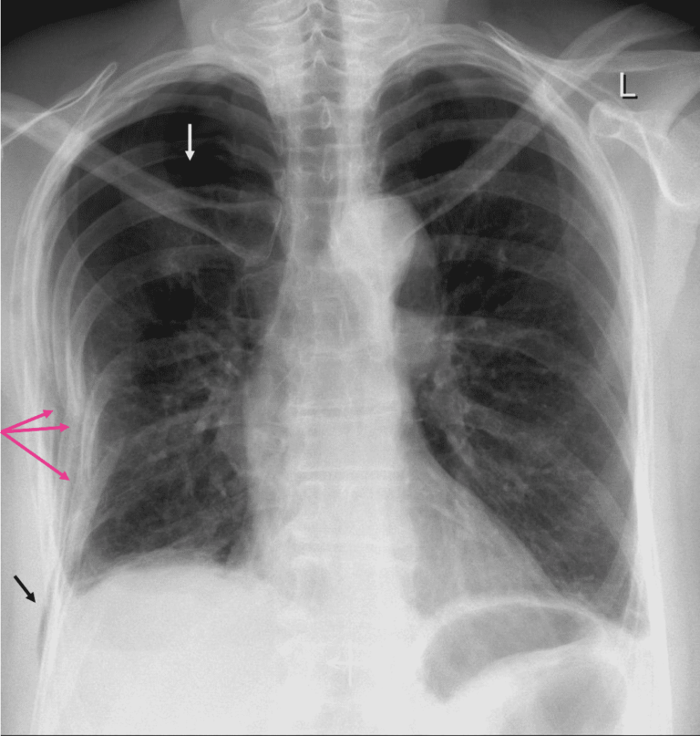 Thoracic Trauma - Hyperexcision