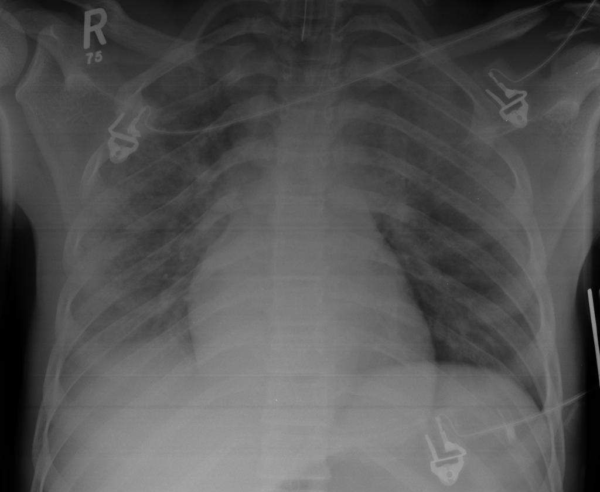 Thoracic Trauma - Hyperexcision