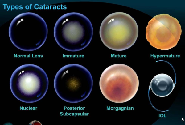 Cataracts - Hyperexcision