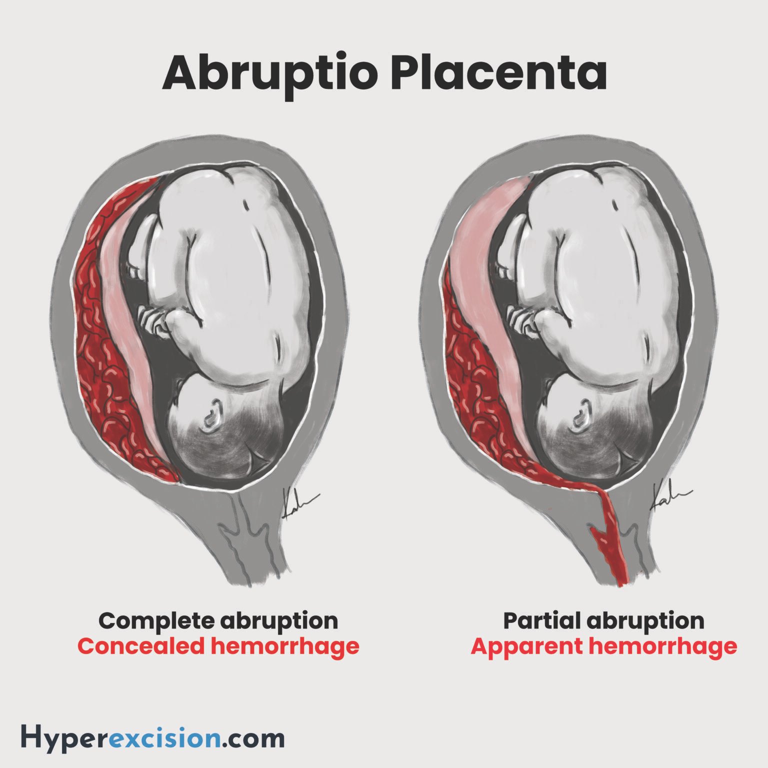 Placental Abruption (Abruptio Placentae) - Hyperexcision