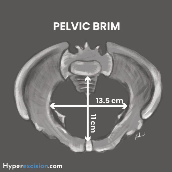 Pelvic Assessment and Cephalopelvic Disproportion (CPD) - Hyperexcision